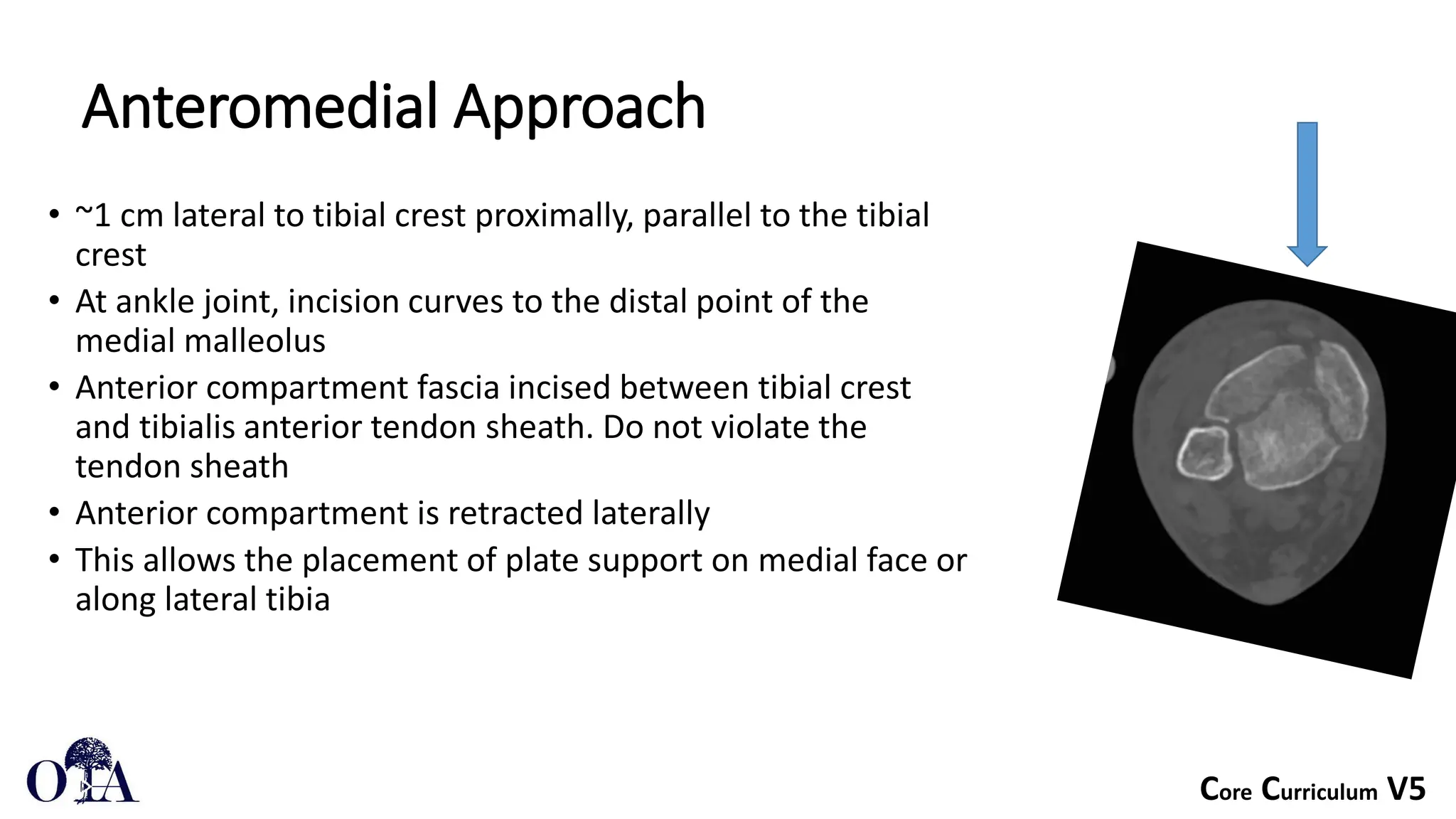 Pilon Fractures definition and classification | PDF