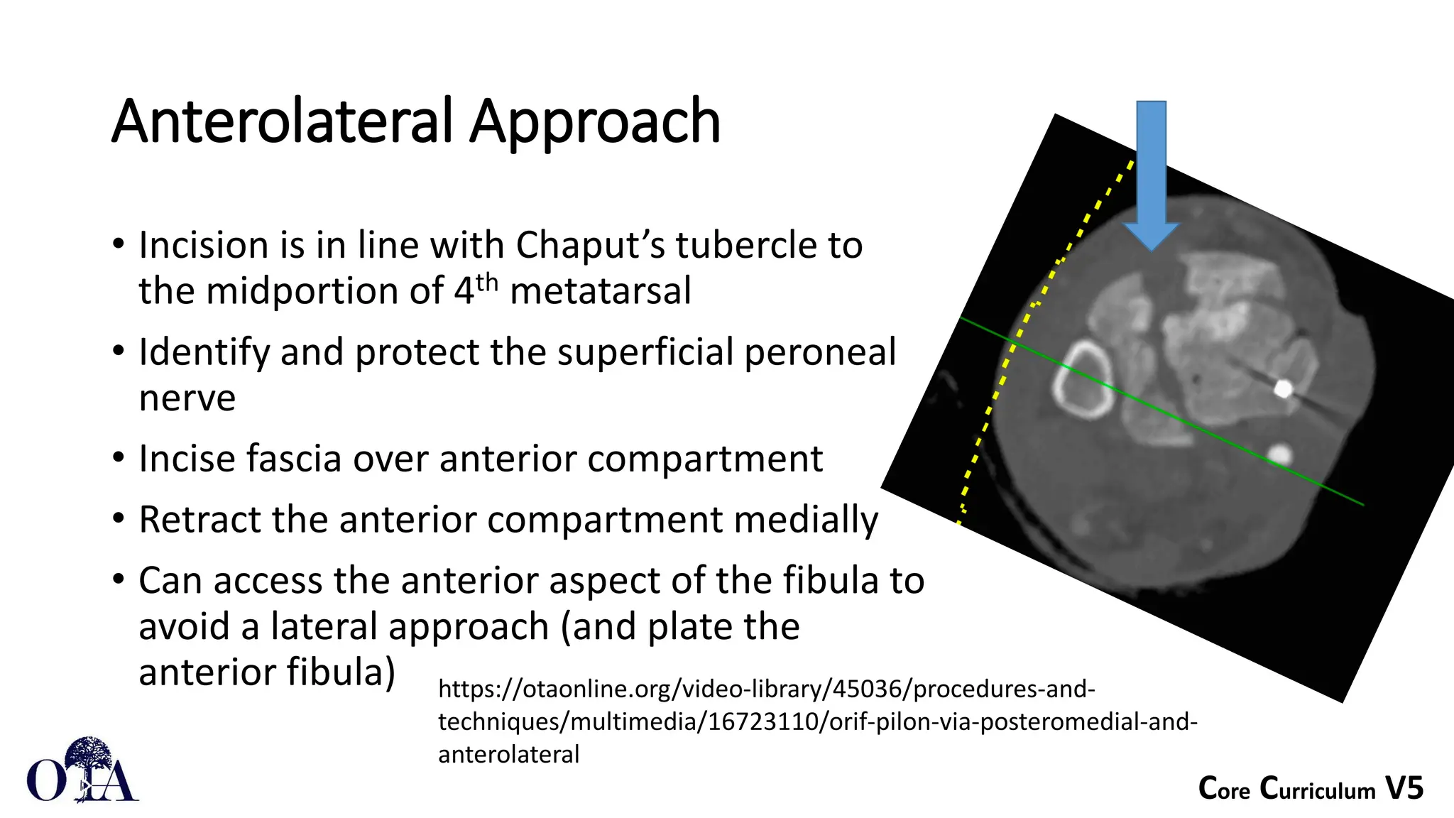 Pilon Fractures definition and classification | PDF