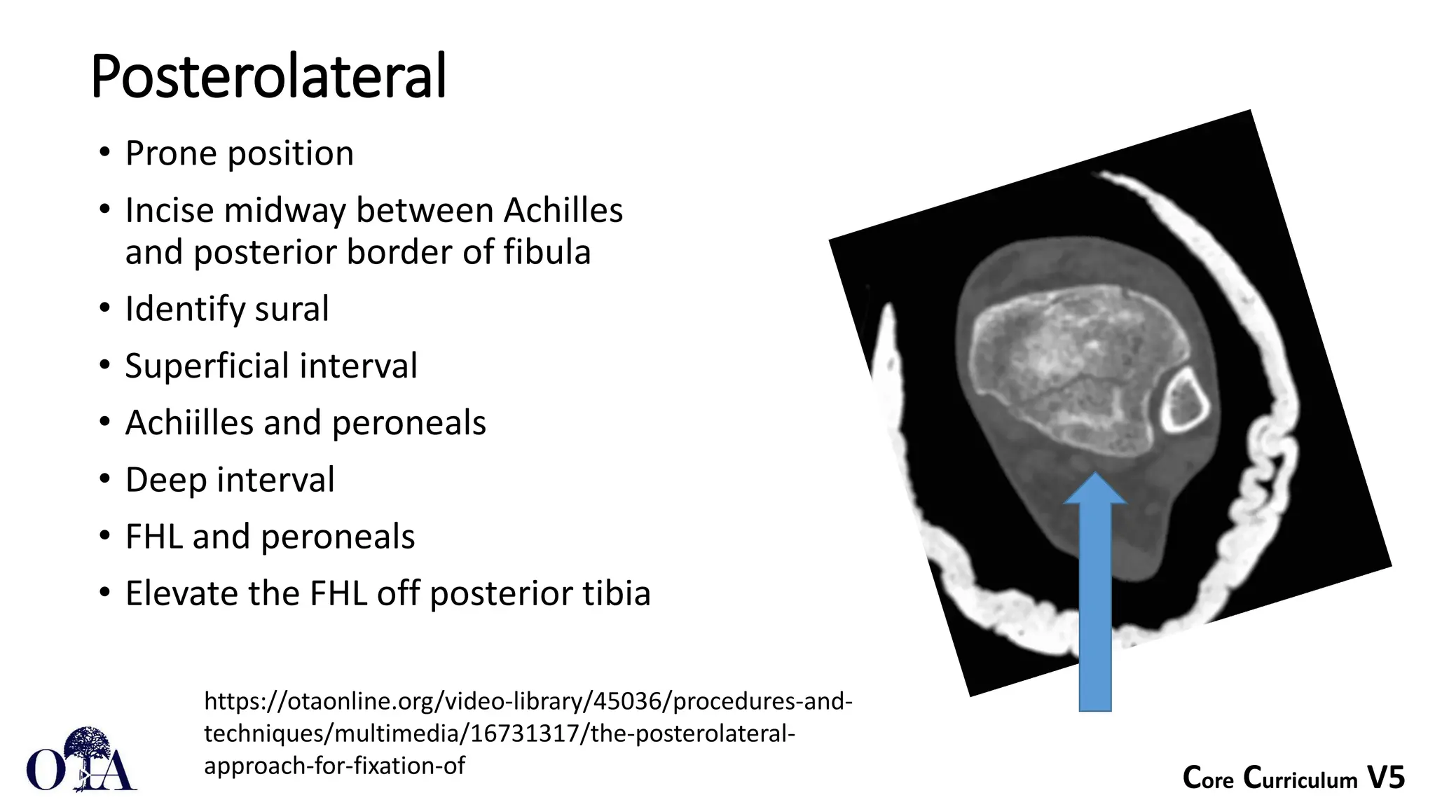 Pilon Fractures definition and classification | PDF