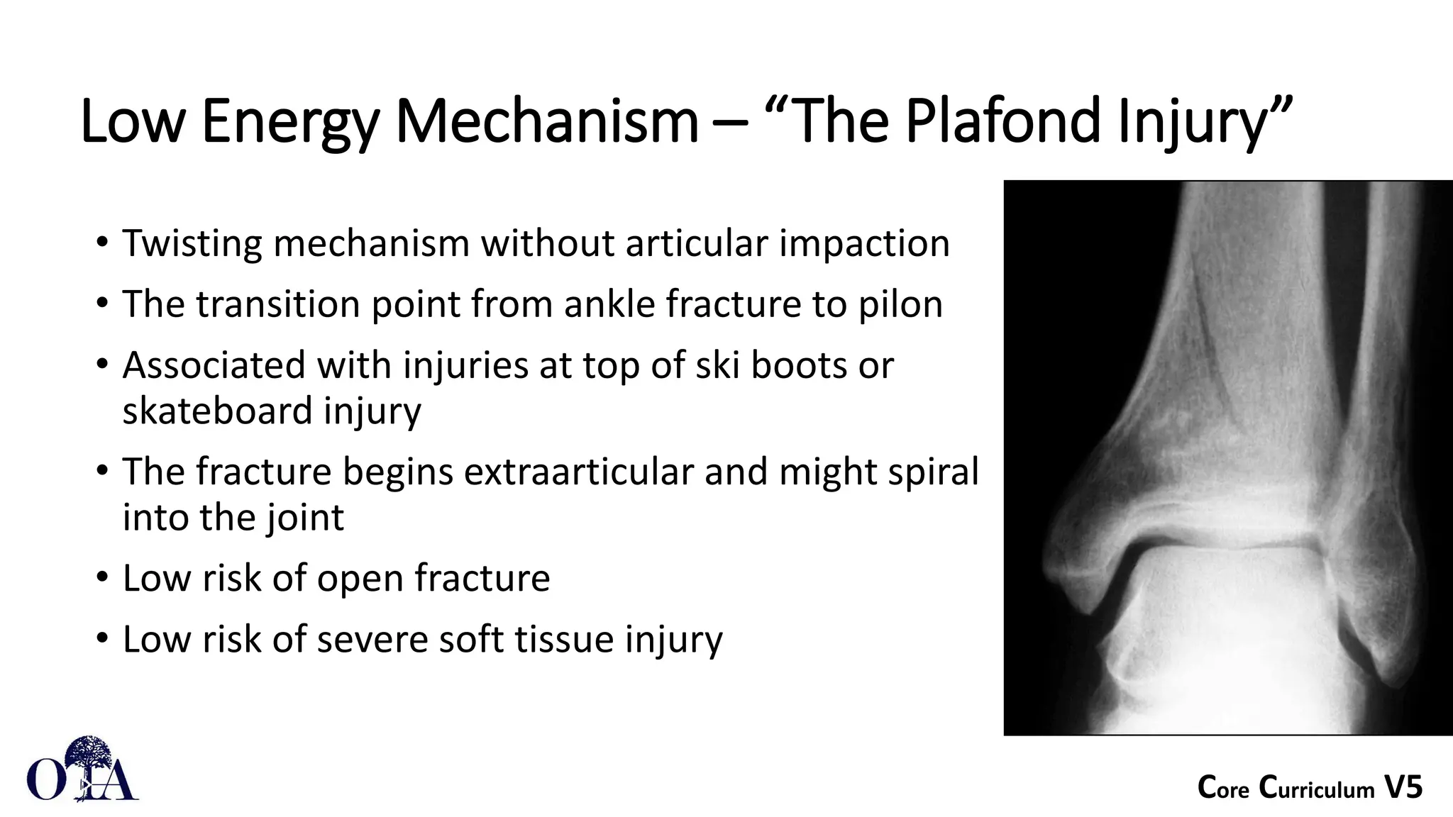 Pilon Fractures definition and classification | PDF