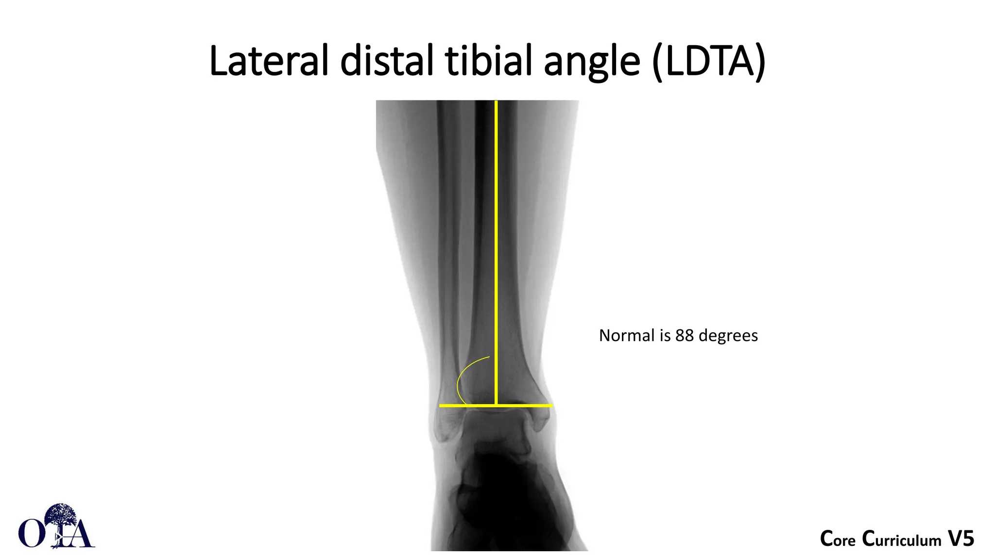 Pilon Fractures definition and classification | PDF