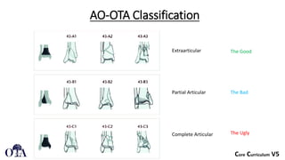 Pilon Fractures definition and classification | PDF