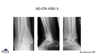 Pilon Fractures definition and classification | PDF