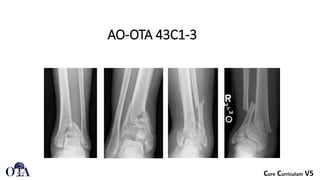Pilon Fractures definition and classification | PDF