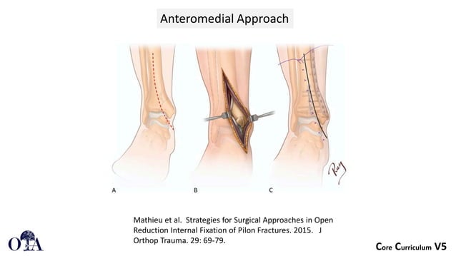 Pilon Fractures definition and classification | PDF
