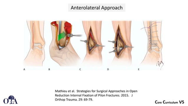 Pilon Fractures definition and classification | PDF