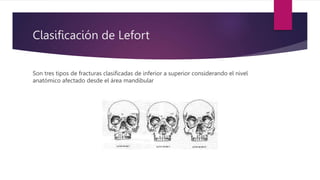 clasifcacion de lefort junto a intubaciones | PPTX