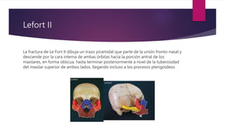 clasifcacion de lefort junto a intubaciones | PPTX