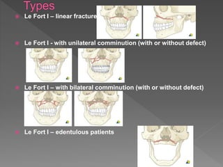 Le Fort Fracture Of Ankle