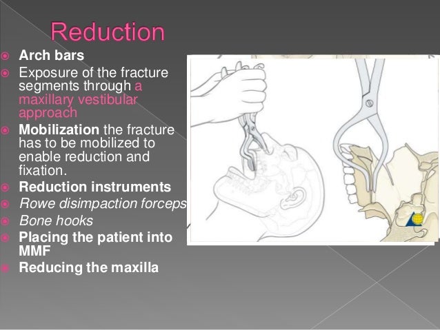 Lefort Fracture Repair