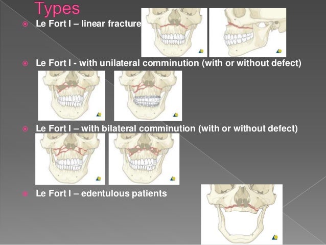 Open fixation for le fort fracture - xtraquest