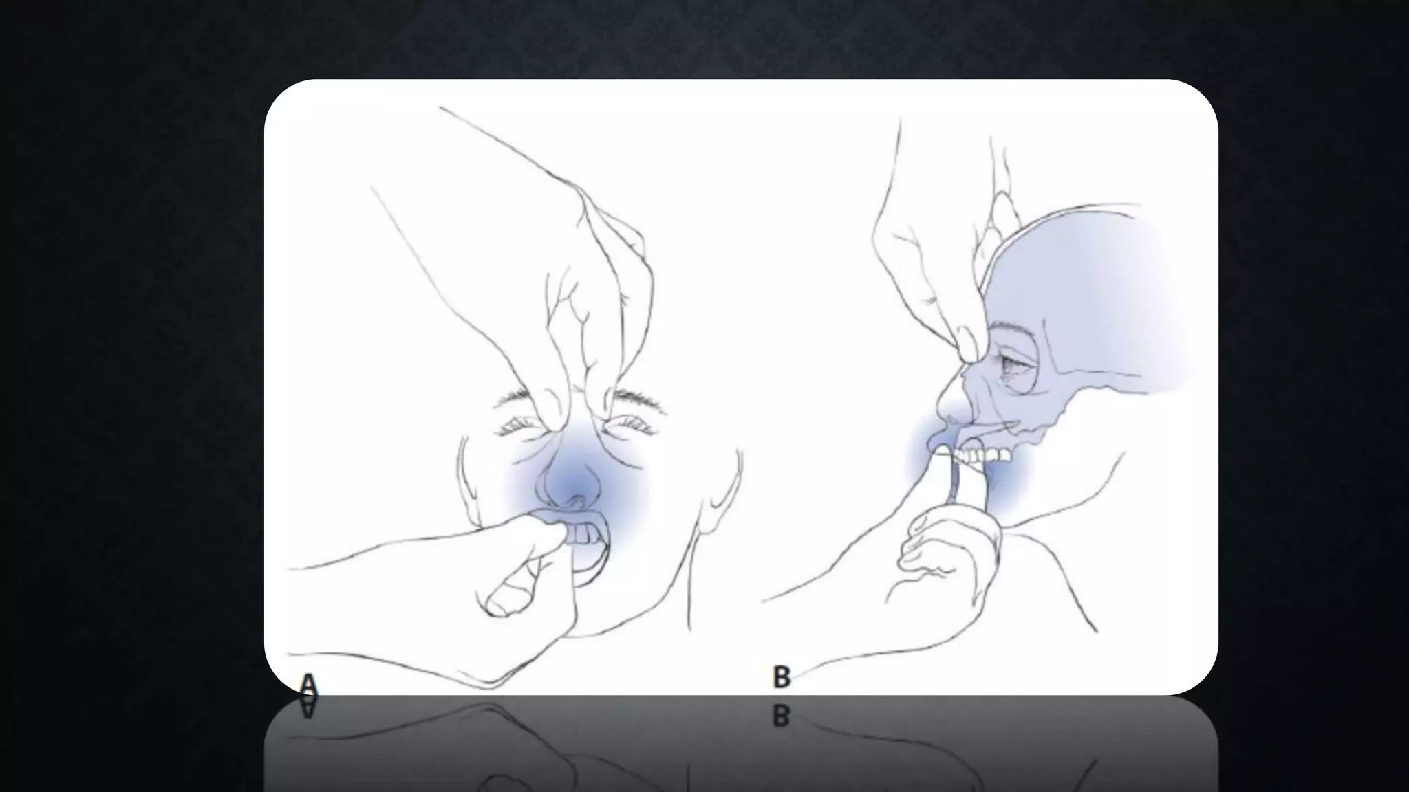 Lefort 1 fracture | PPTX