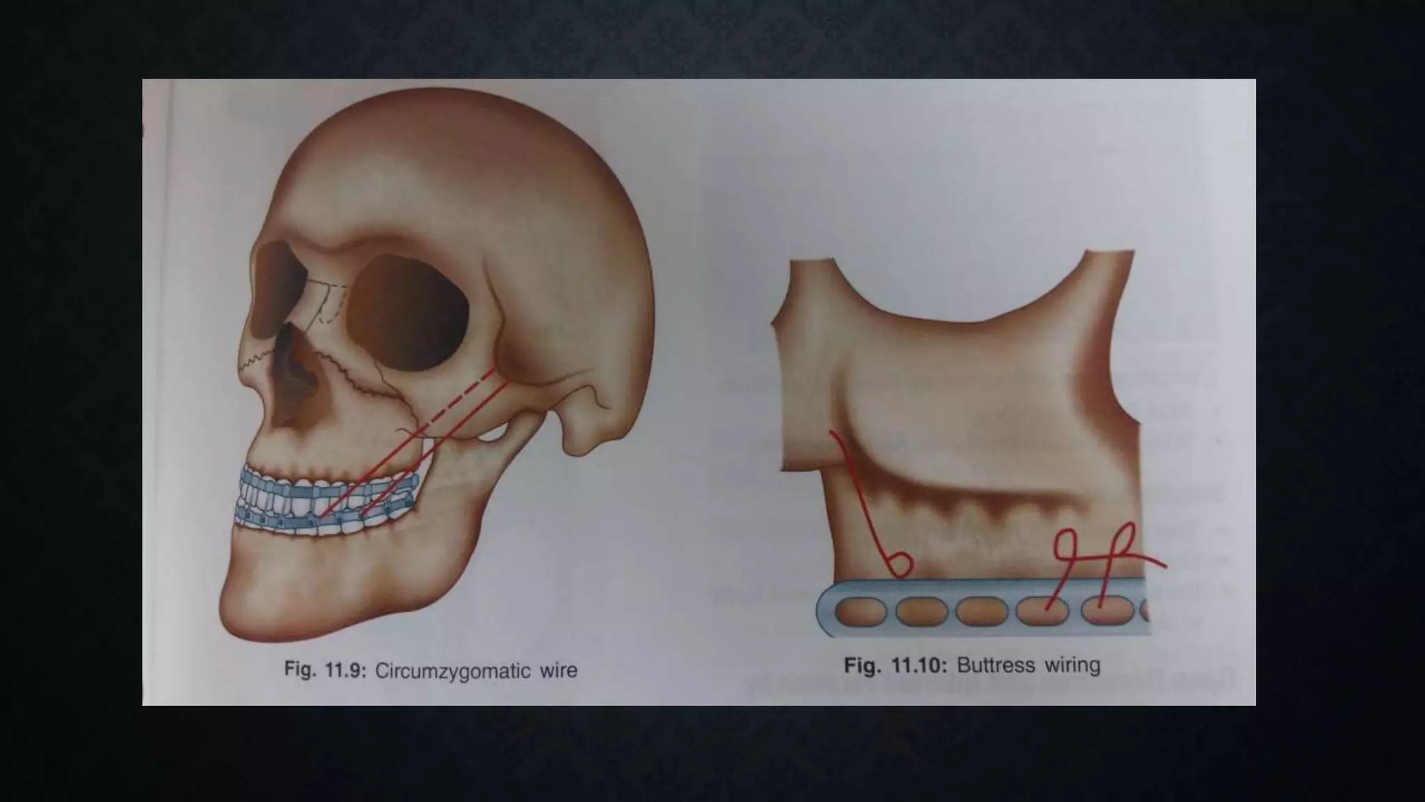 Lefort 1 fracture | PPTX