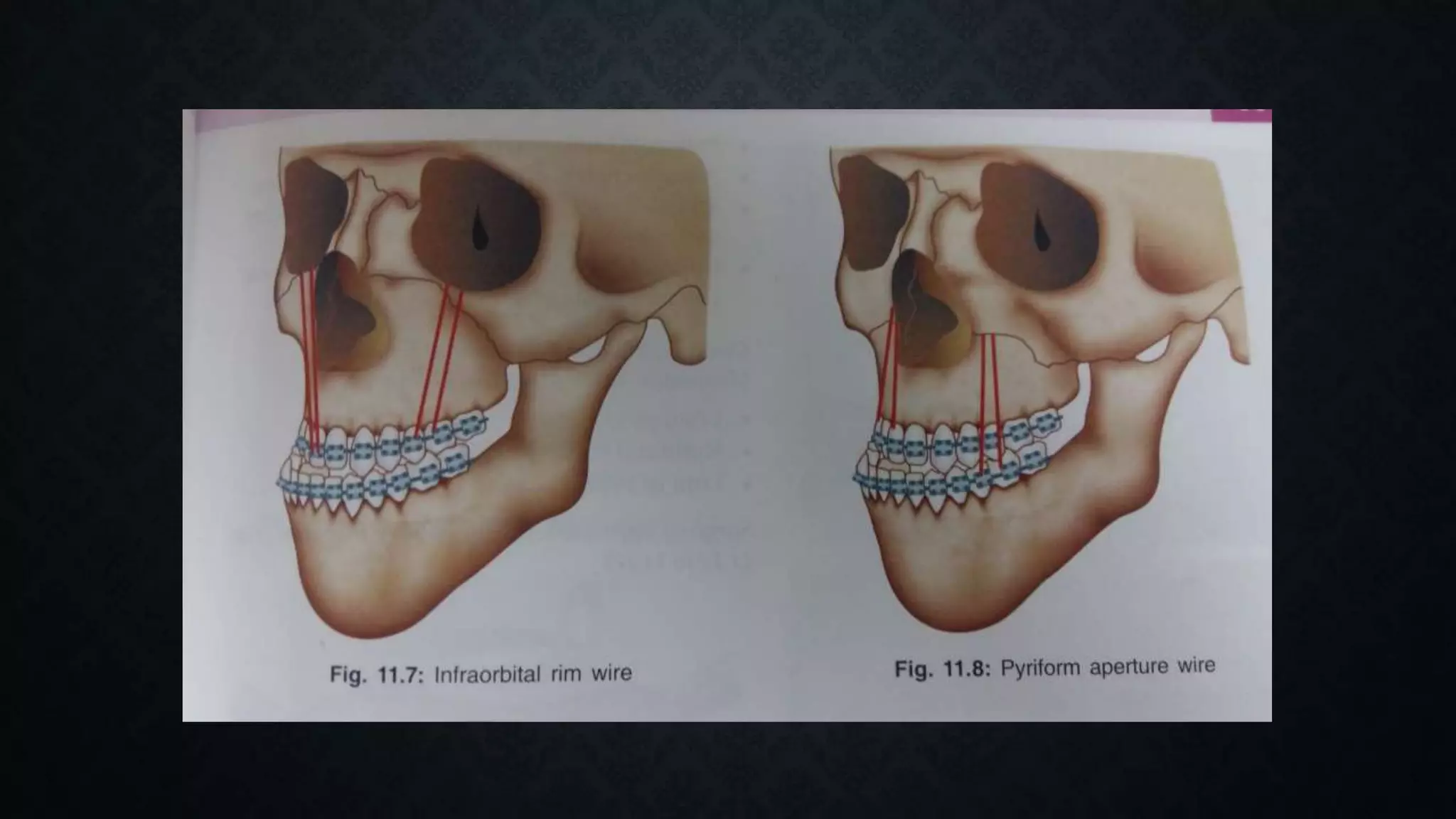 Lefort 1 fracture | PPTX