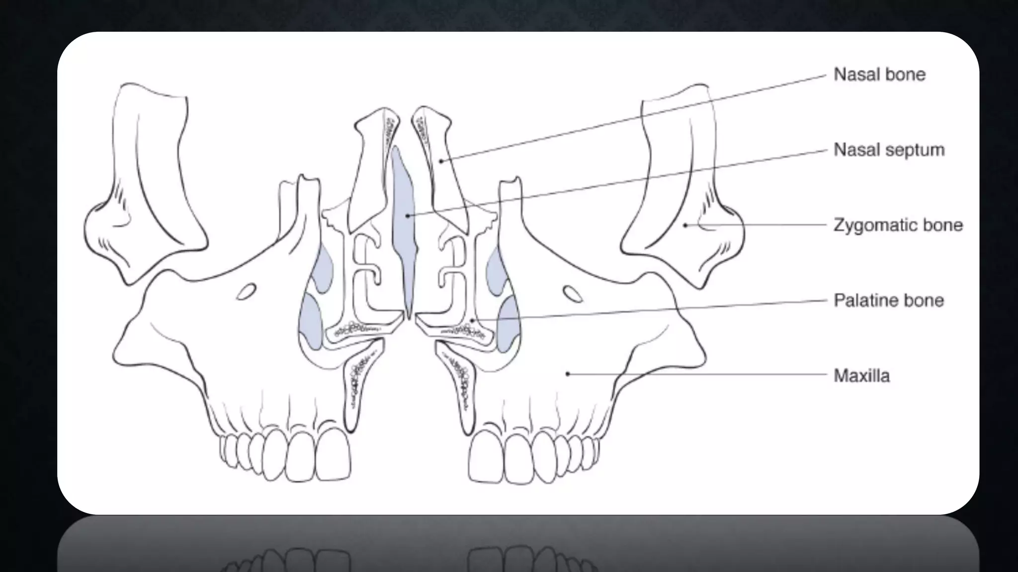 Lefort 1 fracture | PPTX