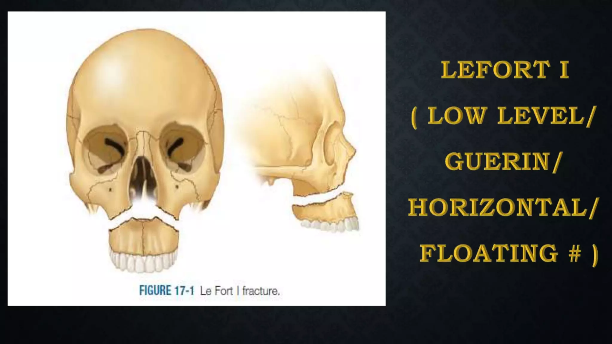 Lefort 1 fracture | PPTX