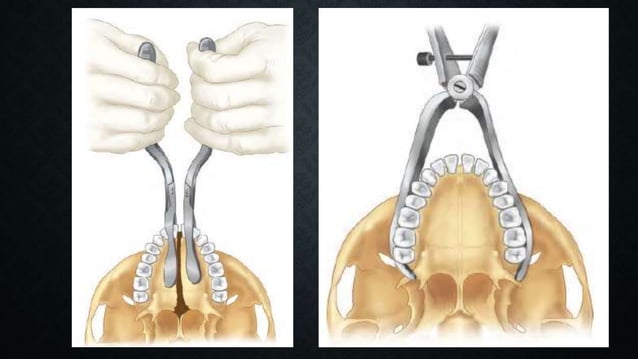 Lefort 1 fracture | PPT