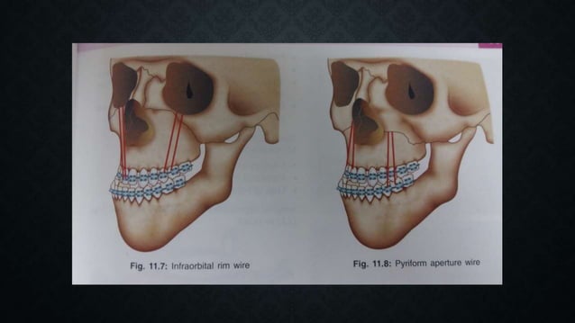 Lefort 1 fracture | PPTX | Death, Injury, or Military Conflict ...