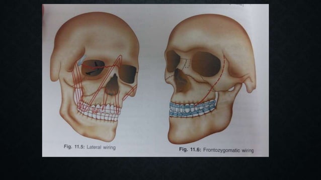 Lefort 1 fracture | PPTX | Death, Injury, or Military Conflict ...