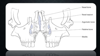 Lefort 1 fracture | PPTX