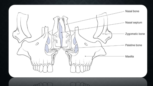 Lefort 1 fracture | PPTX | Death, Injury, or Military Conflict ...