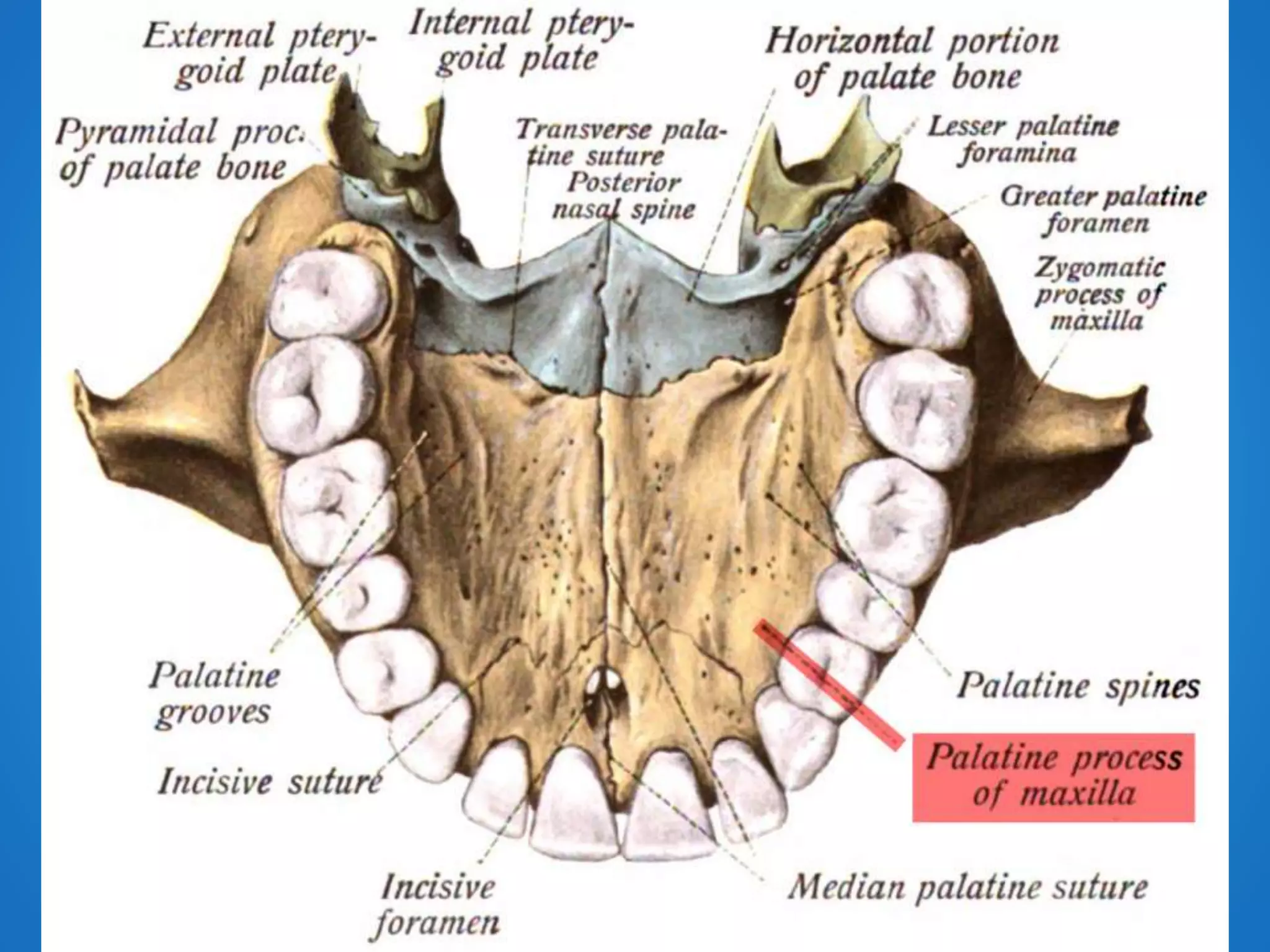 Lefort 1 osteotomy | PPTX