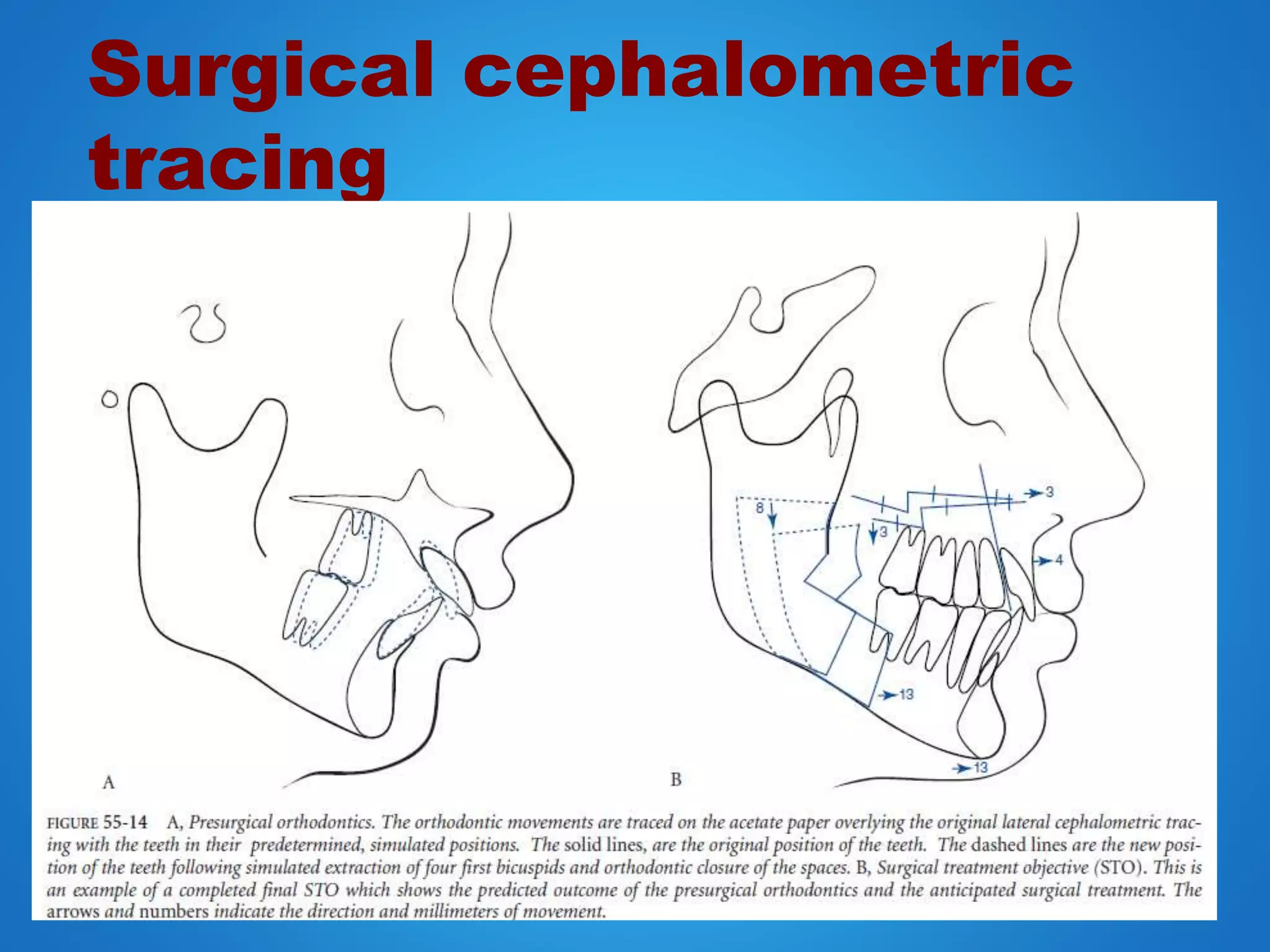 Lefort 1 osteotomy | PPTX