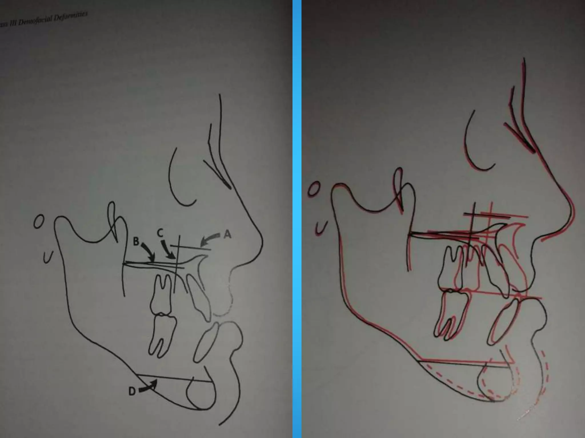Lefort 1 osteotomy | PPTX