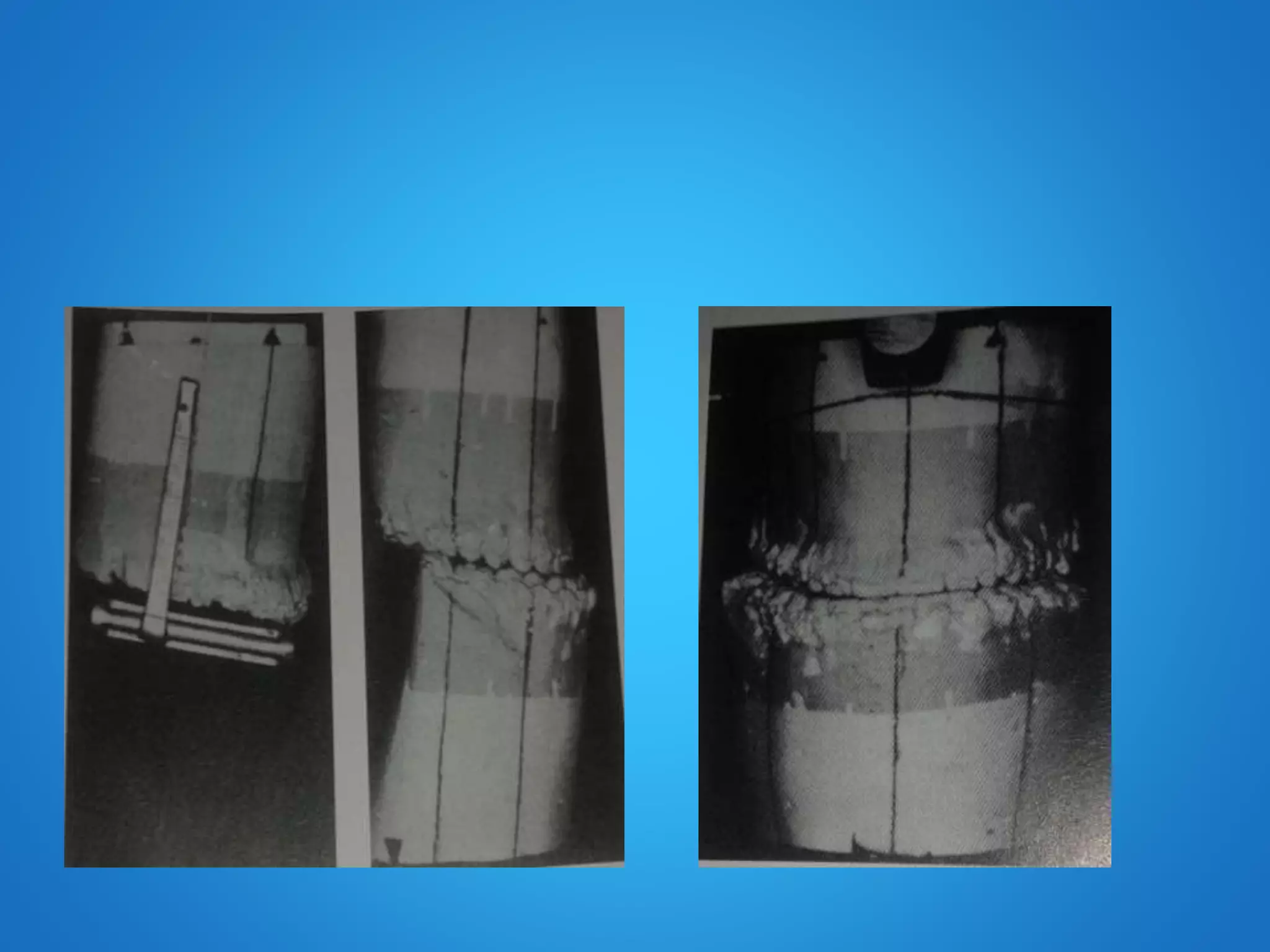 Lefort 1 osteotomy | PPTX