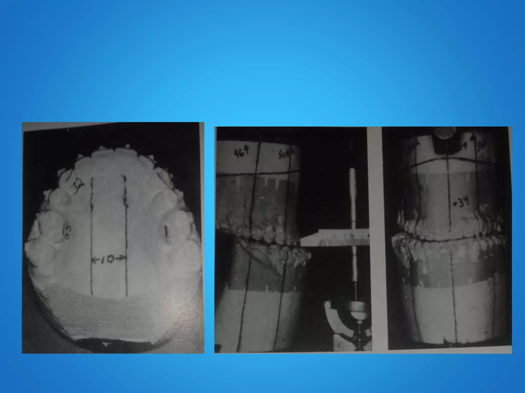 Lefort 1 osteotomy | PPTX