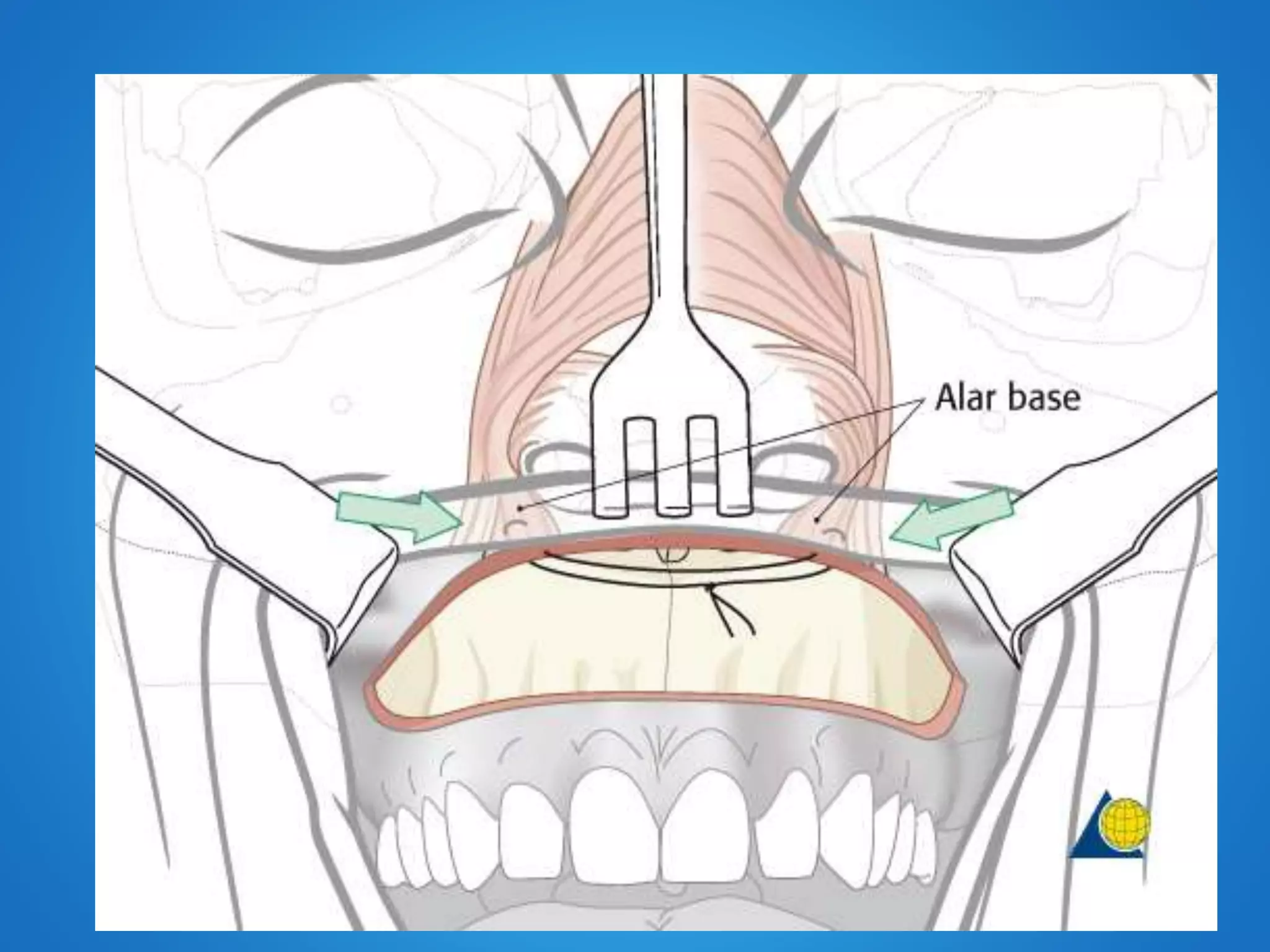 Lefort 1 osteotomy | PPTX | Bone and Joint Conditions | Diseases and ...