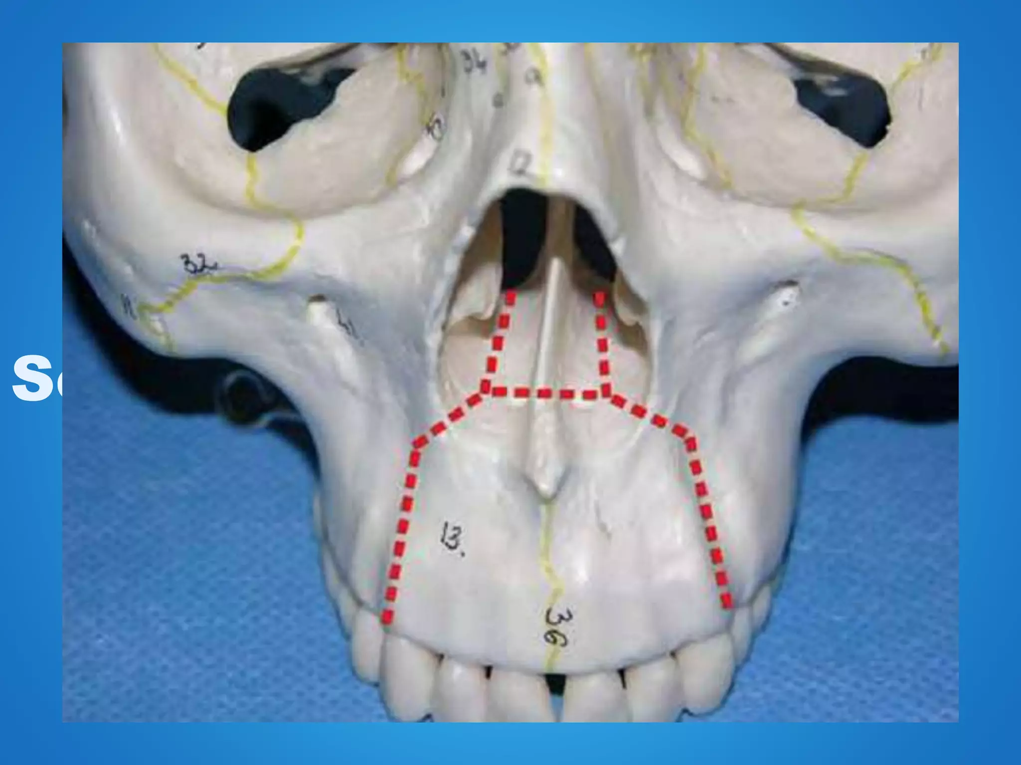 Lefort 1 osteotomy | PPTX