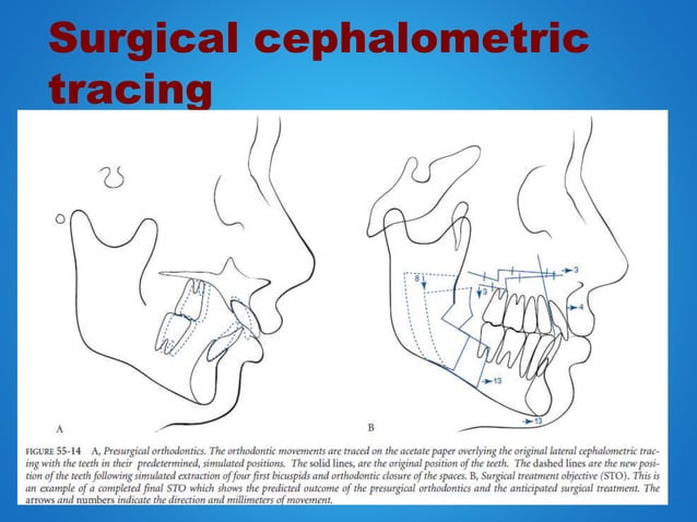 Lefort 1 osteotomy | PPTX | Bone and Joint Conditions | Diseases and ...