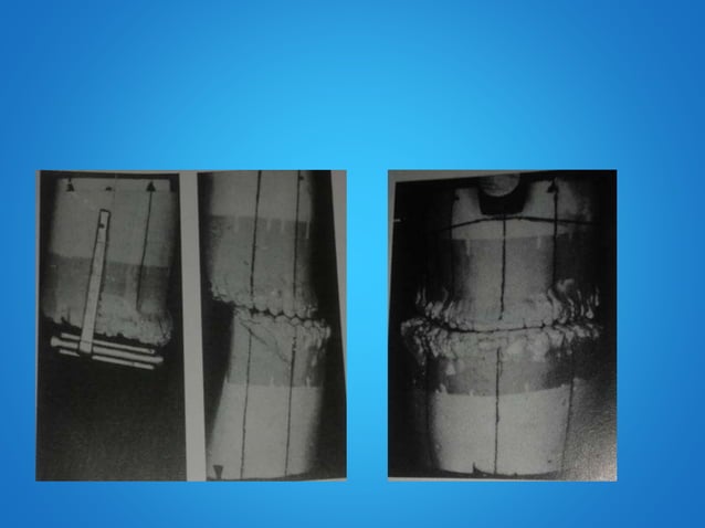 Lefort 1 osteotomy | PPTX | Bone and Joint Conditions | Diseases and ...