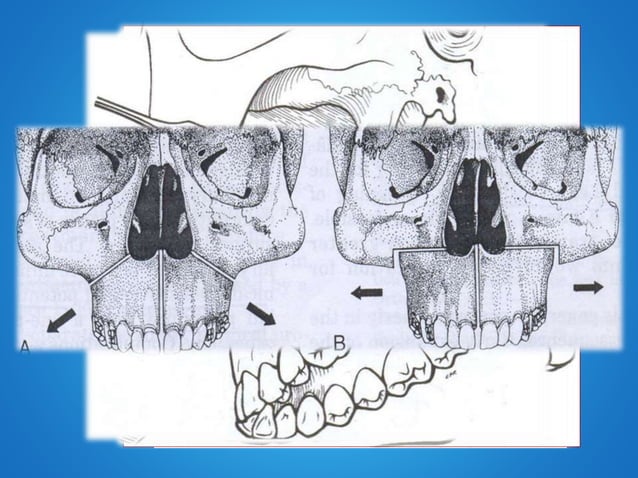 Lefort 1 osteotomy | PPTX | Bone and Joint Conditions | Diseases and ...