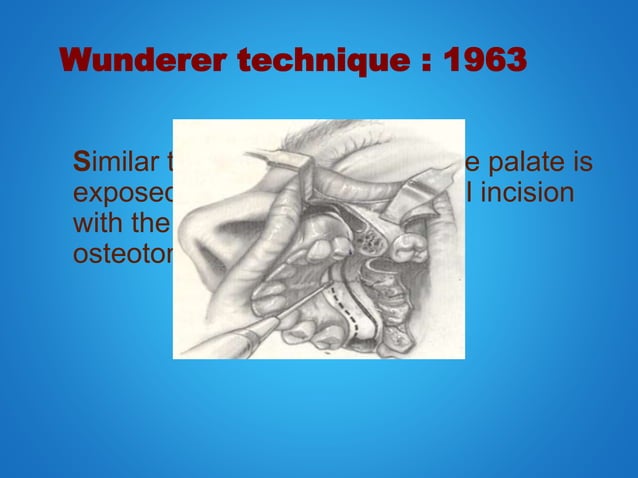Lefort 1 osteotomy | PPT