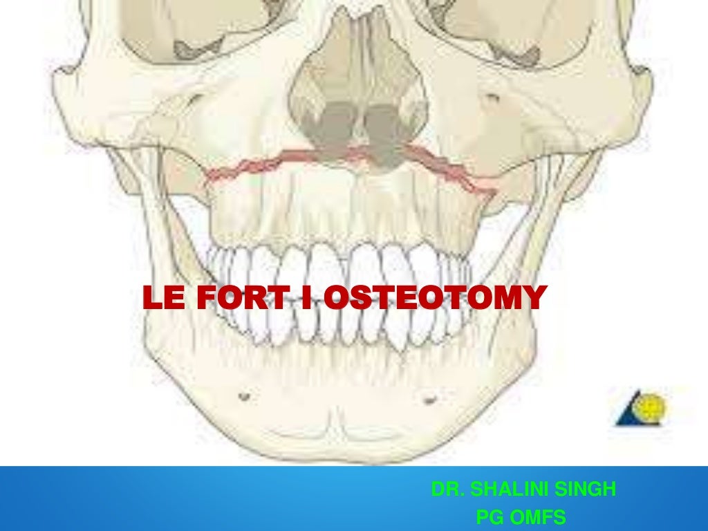 Lefort 1 osteotomy