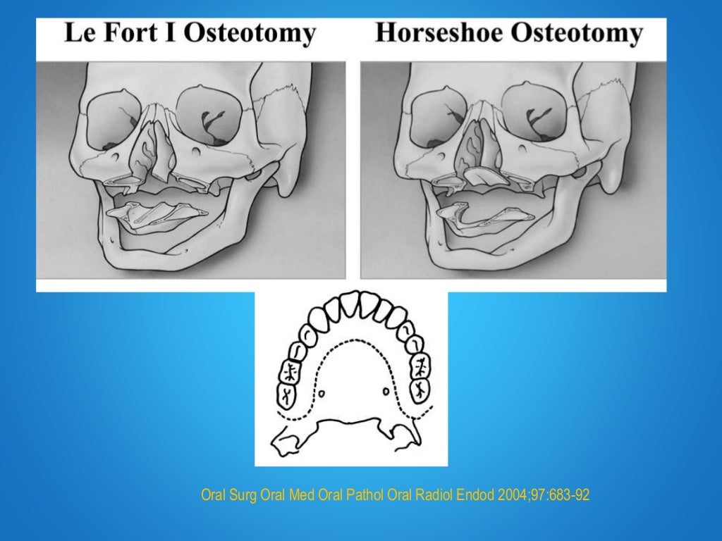 Lefort 1 osteotomy