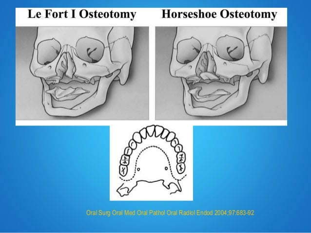 Lefort 1 osteotomy