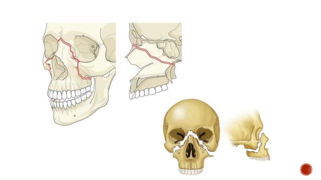 Lefort 2 fracture | PPTX | First Aid | Injuries