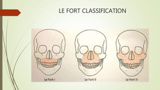 Lefort and anesthesia | PPTX
