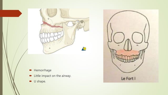 Lefort and anesthesia | PPTX