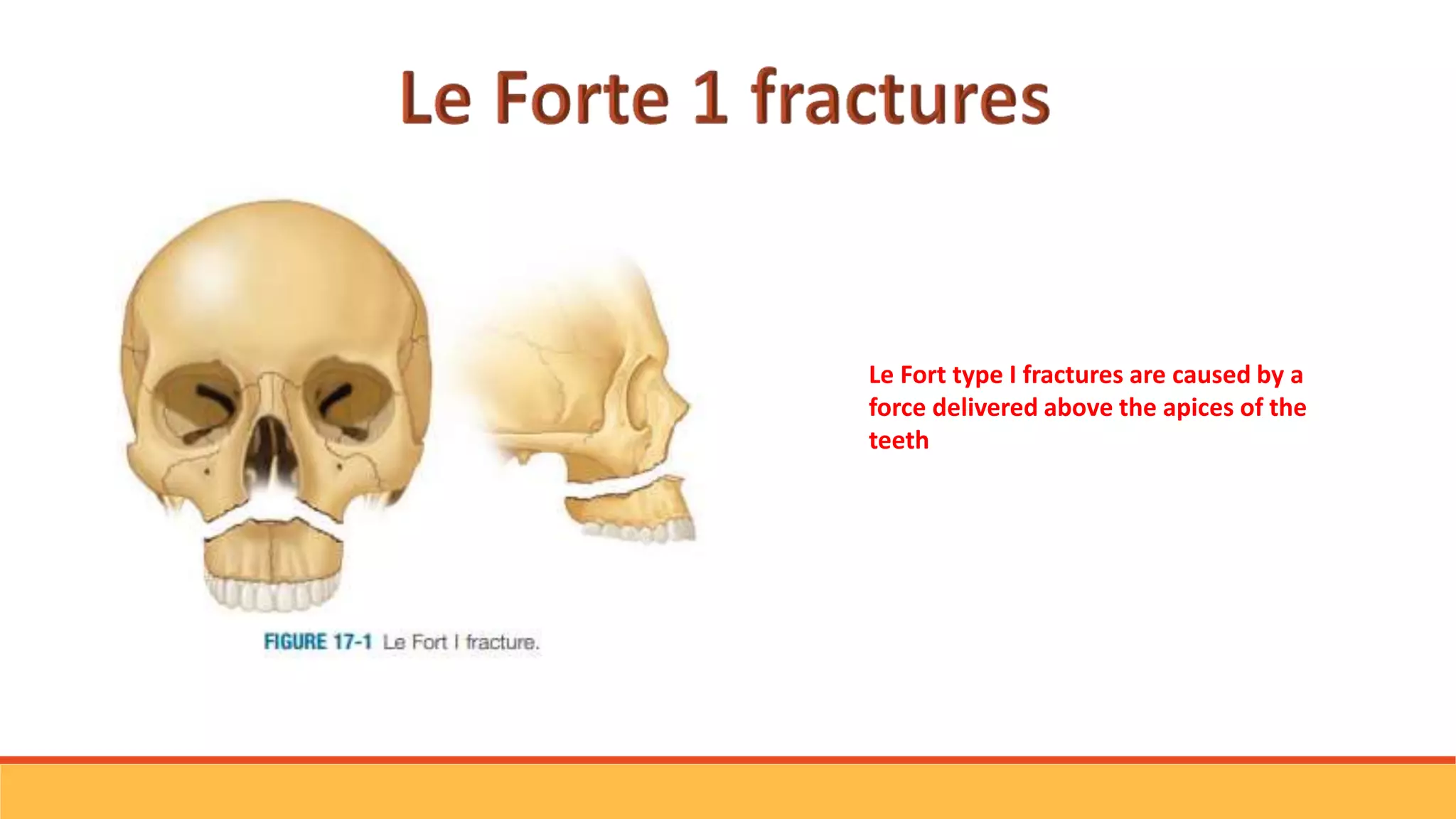 Le Forte Fractures (1).pptx