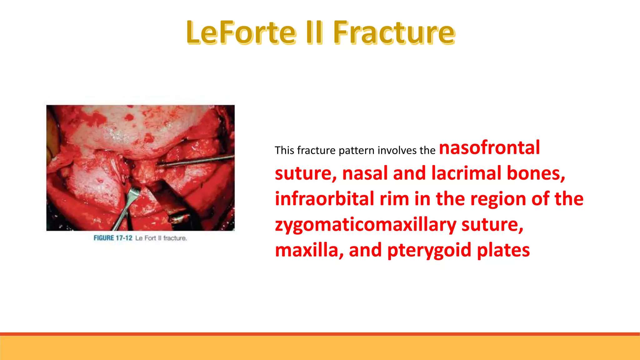 Le Forte Fractures (1).pptx