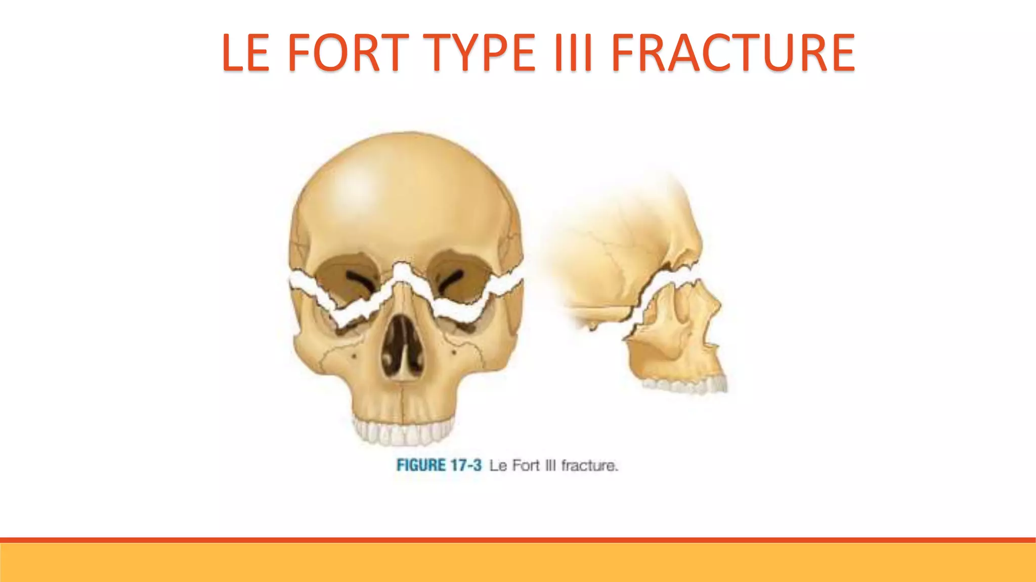 Le Forte Fractures (1).pptx