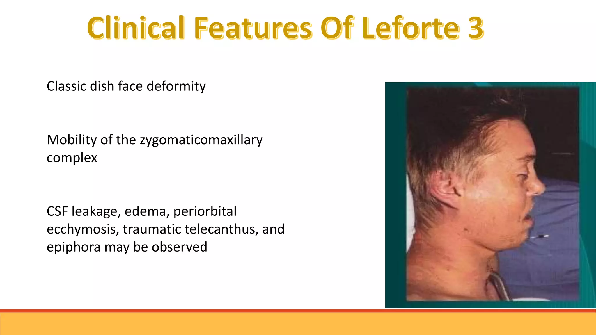 Le Forte Fractures (1).pptx