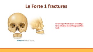 Le Forte Fractures (1).pptx