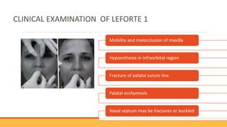 Le Forte Fractures (1).pptx