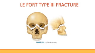 Le Forte Fractures (1).pptx