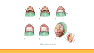 Le Forte Fractures (1).pptx
